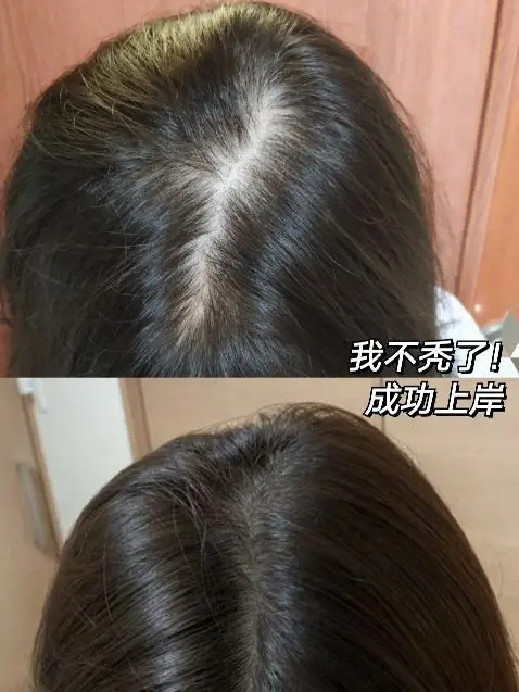 Raising hair is so fulfilling! The hairline is successfully raised ...