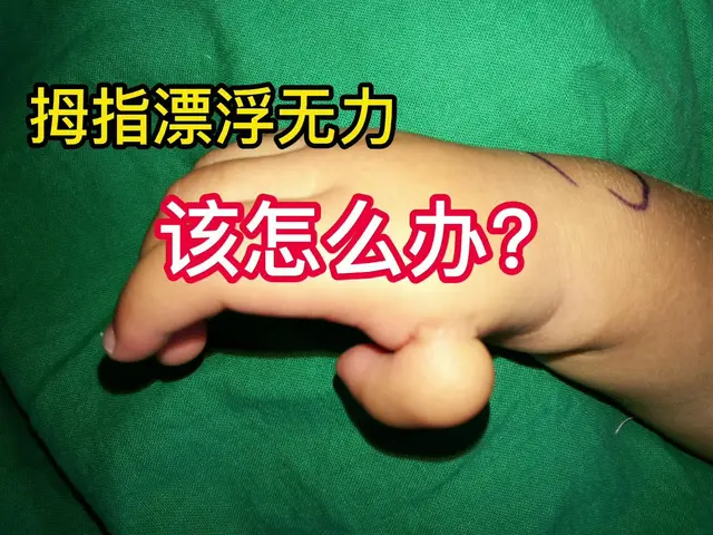 The baby is 5 months old, and the right thumb is a floating thumb. Is ...