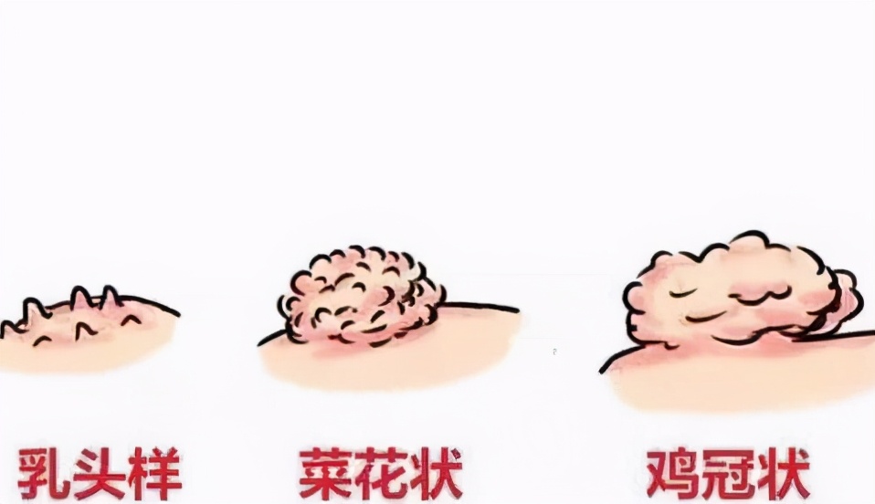 尖锐湿尤菜花状菜花尖锐疣图片症状大山谷图库